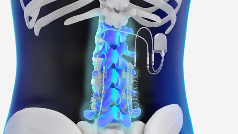 SpF® Bone Growth Stimulator – HIGHRIDGE MEDICAL